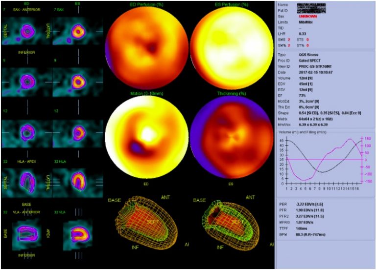The impact of frame numbers on cardiac ECG-gated SPECT images with ...