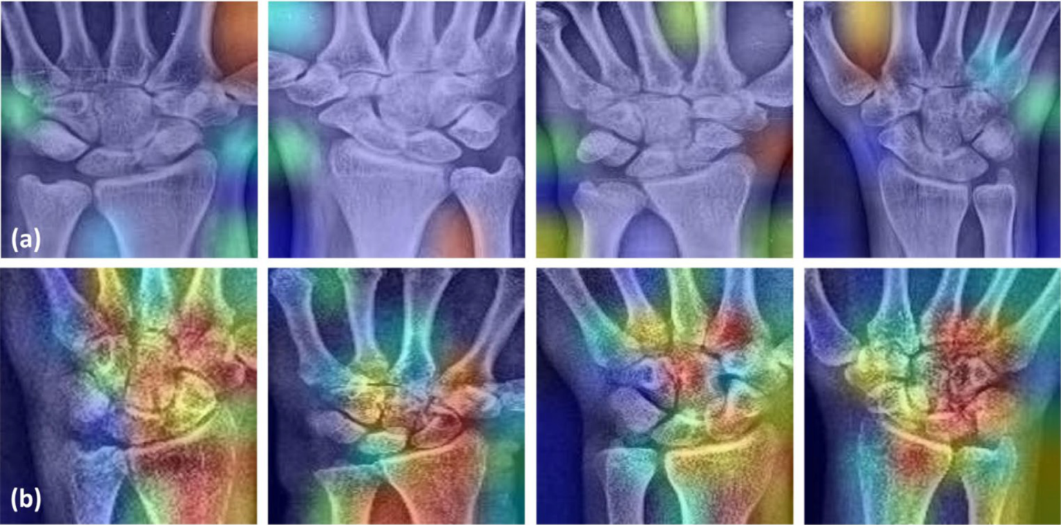 Automated detection of scaphoid fractures using deep neural networks in radiographs - QAMEBI